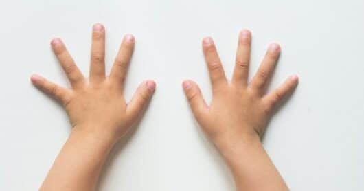 What Is a Herpetic Whitlow? And How Do Children Get It?