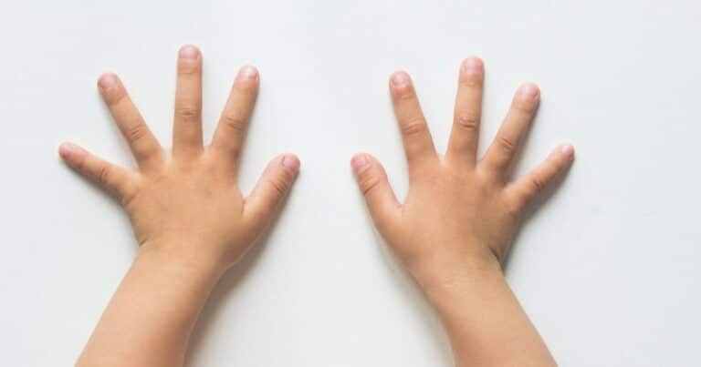 What Is a Herpetic Whitlow? And How Do Children Get It?