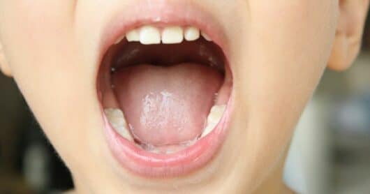 The Problems a High Palate Can Cause in Children